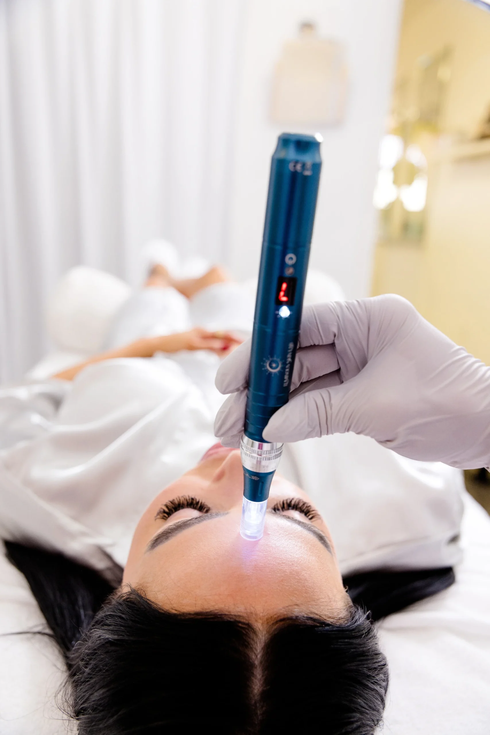 Microneedling Results and Recovery Explained by Professionals